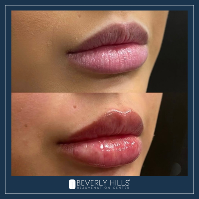 Dermal Fillers – Beverly Hills Med Spa