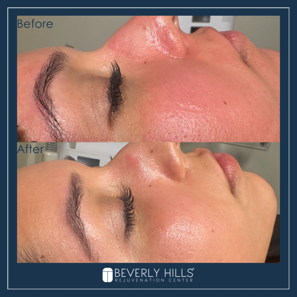 Hydrafacial – Beverly Hills Med Spa